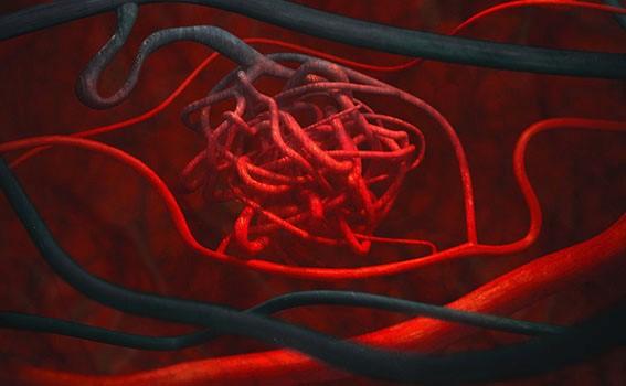 DeviceMD - TRUFILL® n-BCA Liquid Embolic System