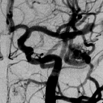 DeviceMD - TRUFILL® n-BCA Liquid Embolic System