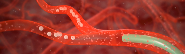 DeviceMD - SIR-Spheres® Y-90 resin microspheres