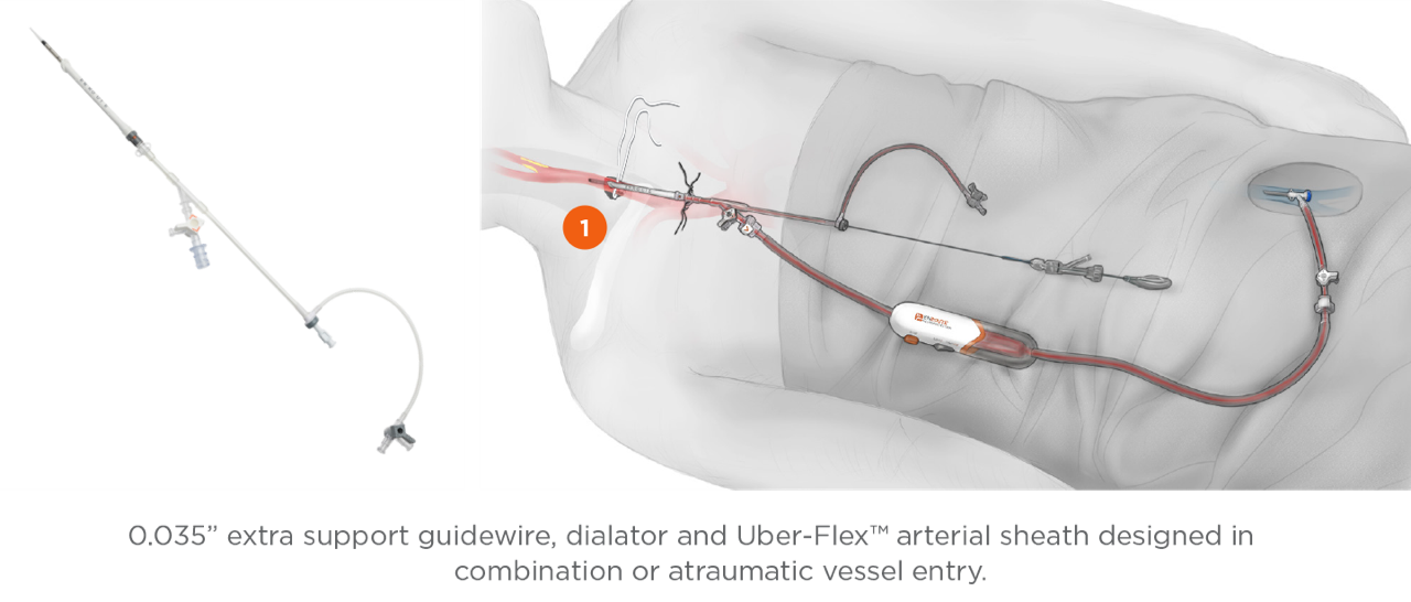DeviceMD - ENROUTE® Transcarotid Neuroprotection System
