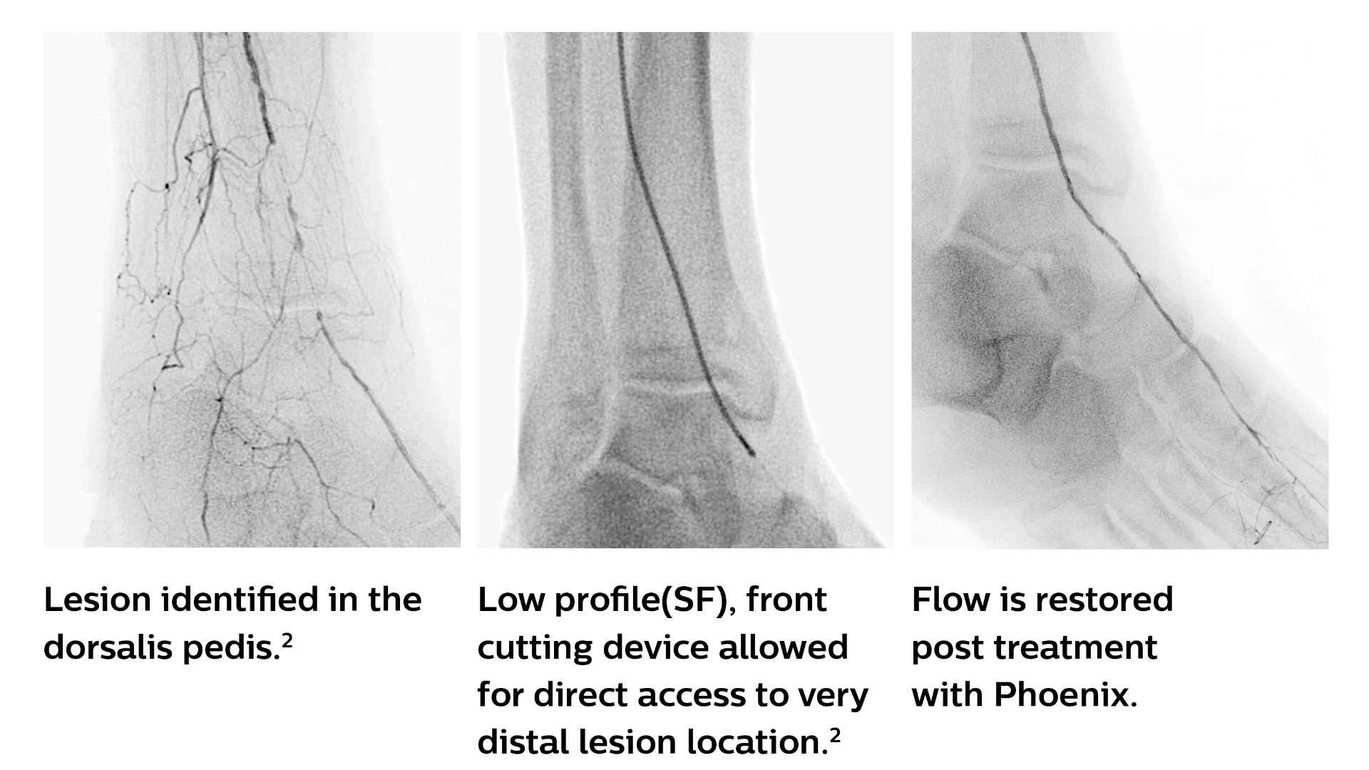 DeviceMD - Phoenix atherectomy system
