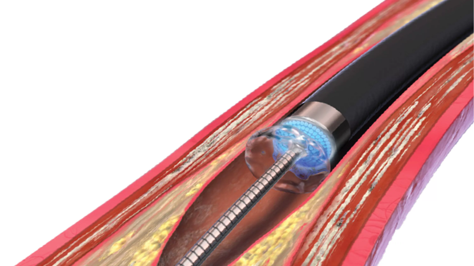 DeviceMD - Turbo-Elite Laser atherectomy catheter