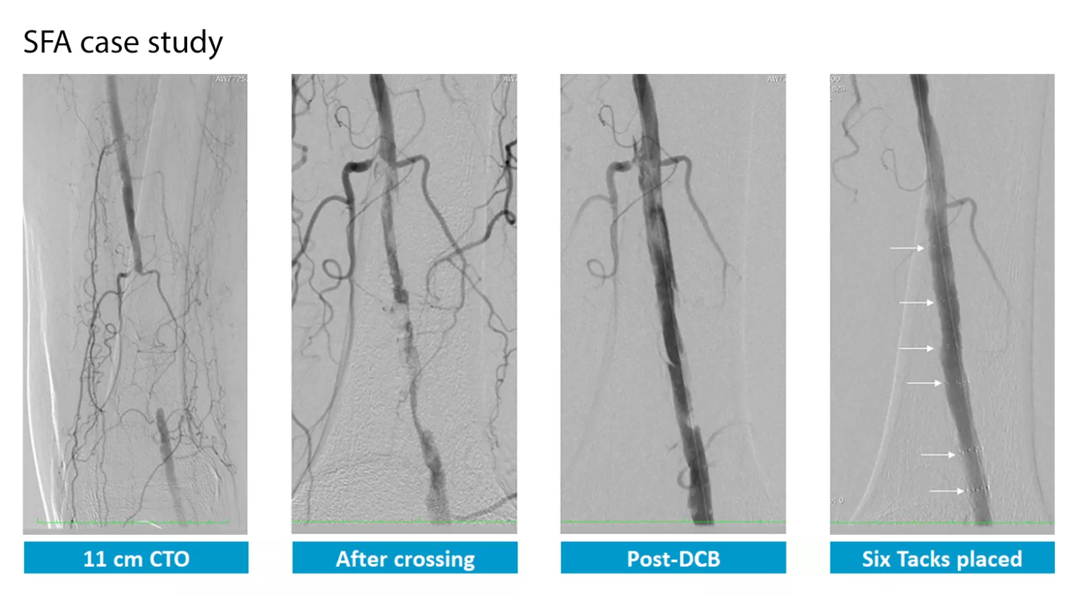 DeviceMD - Tack endovascular system