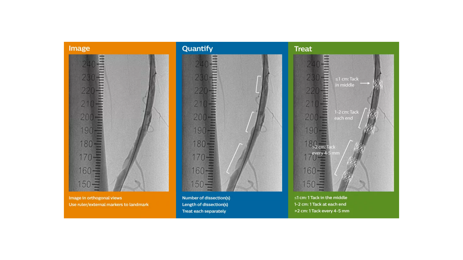 DeviceMD - Tack endovascular system
