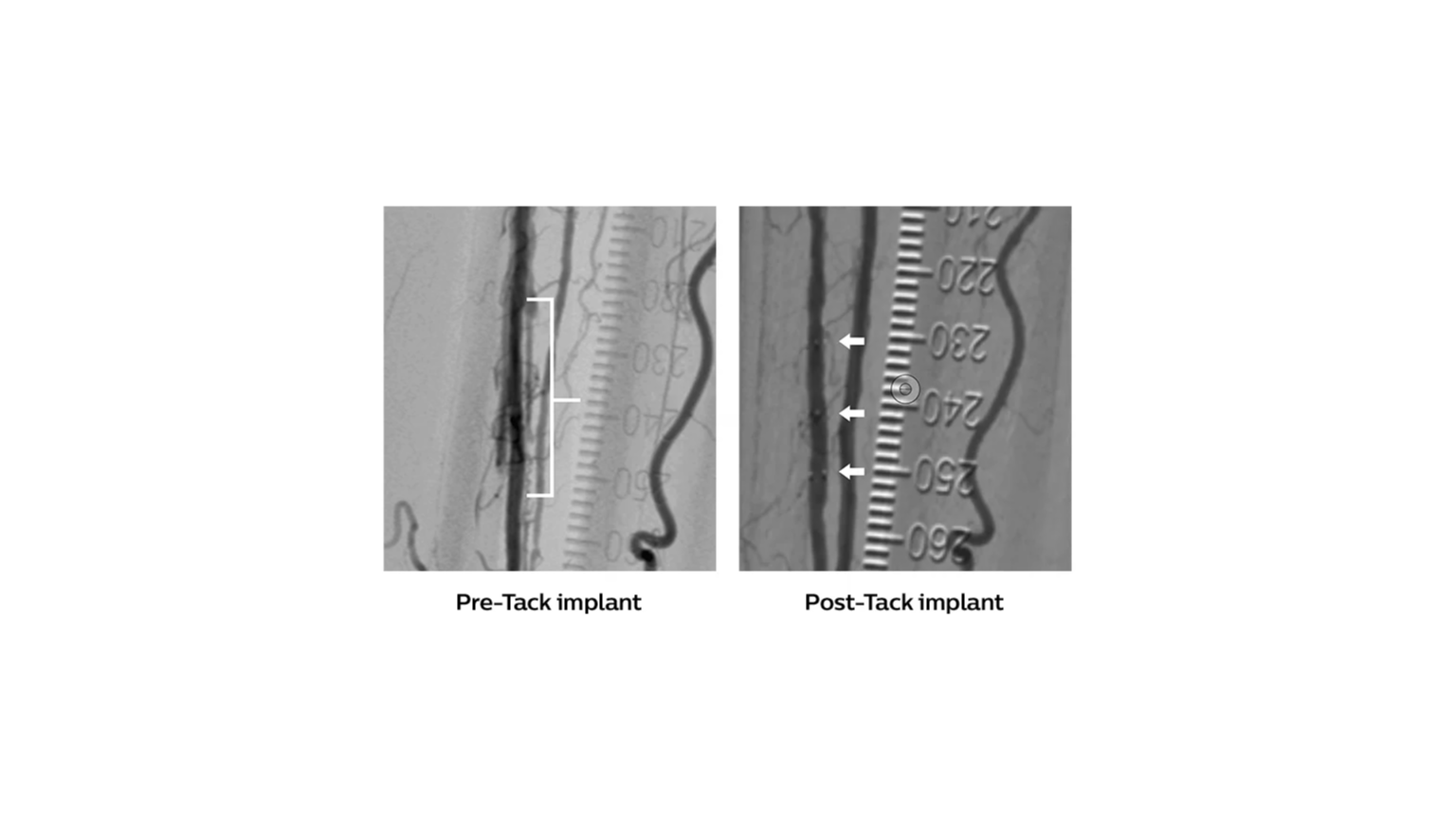 DeviceMD - Tack endovascular system