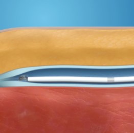 DeviceMD - VENASEAL CLOSURE SYSTEM
