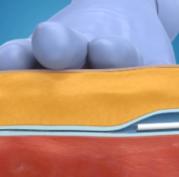 DeviceMD - VENASEAL CLOSURE SYSTEM